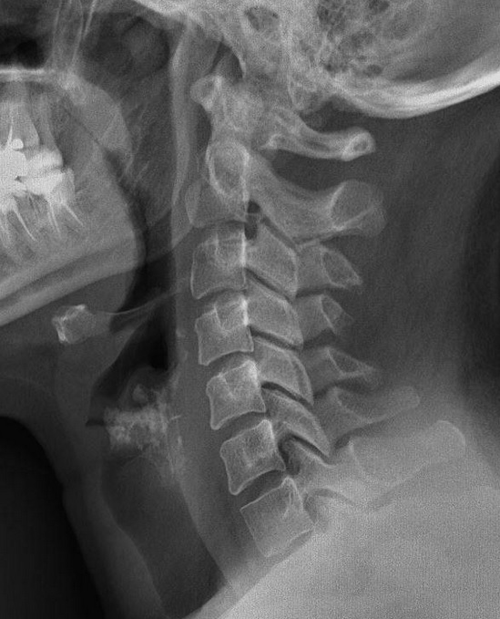Ce que vous devez savoir sur la radio du rachis cervical.